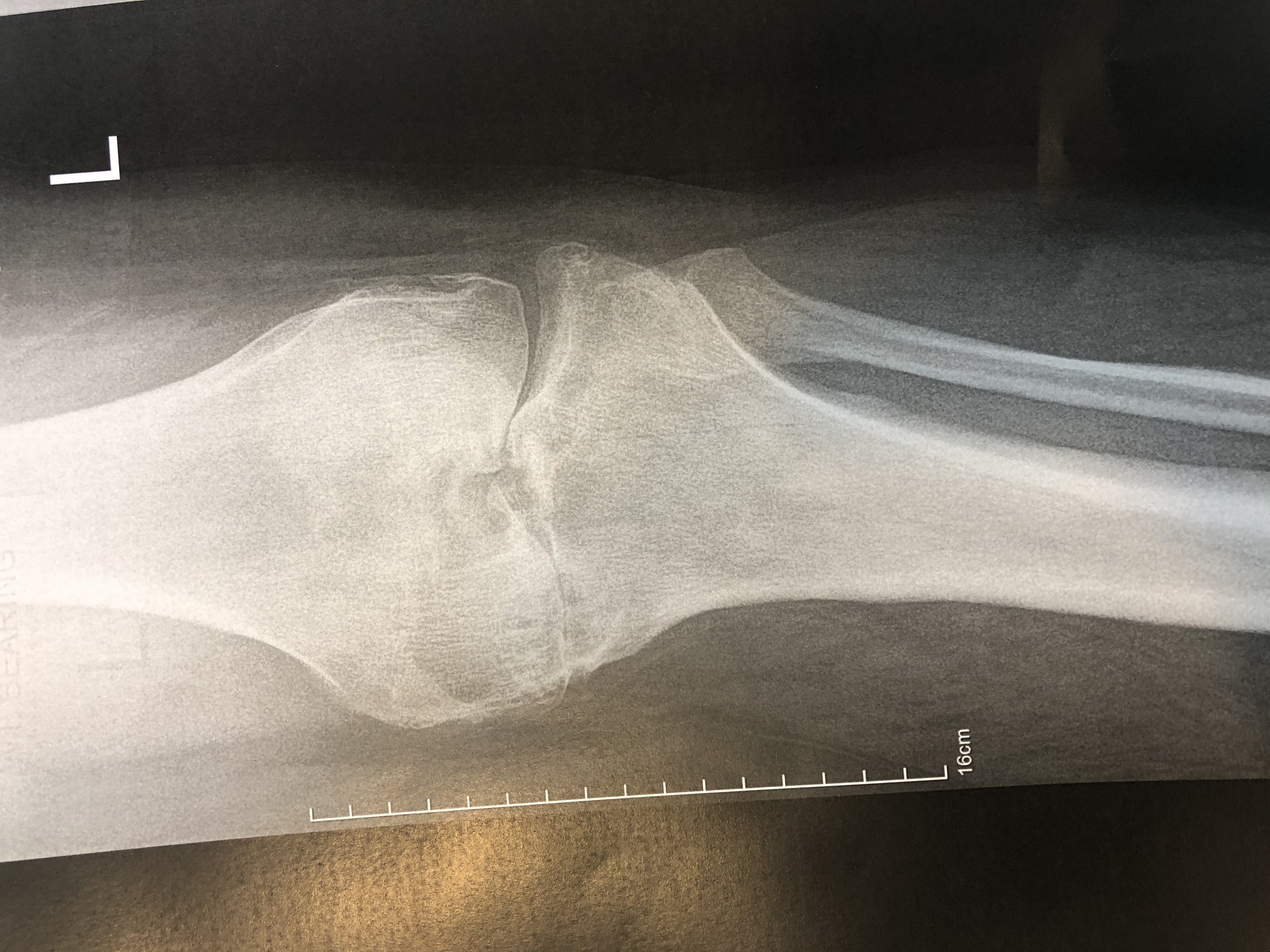 Knee Replacement | A/Prof Peter J Papantoniou Orthopaedic & Spine Surgeon