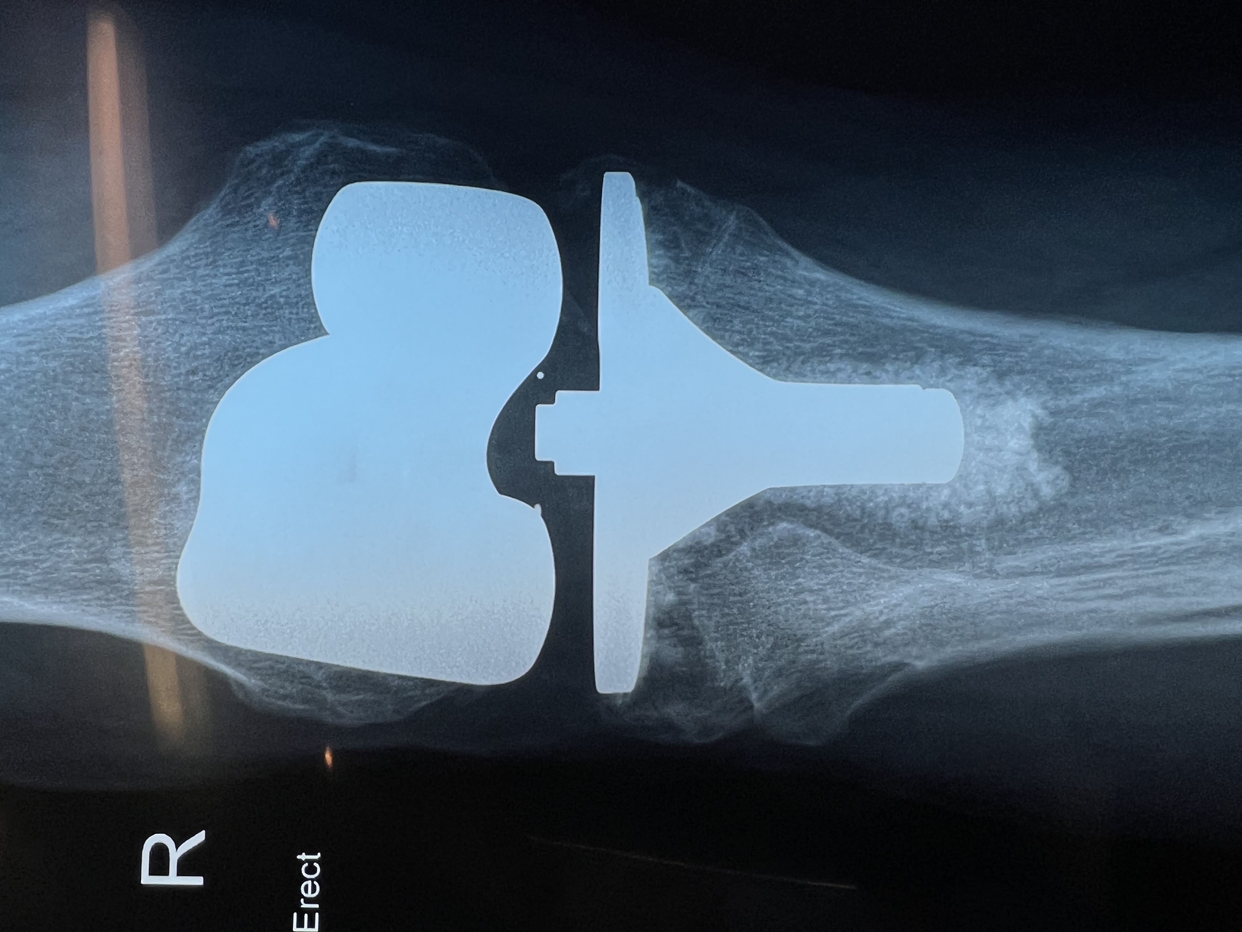 Knee Replacement | A/Prof Peter J Papantoniou Orthopaedic & Spine Surgeon